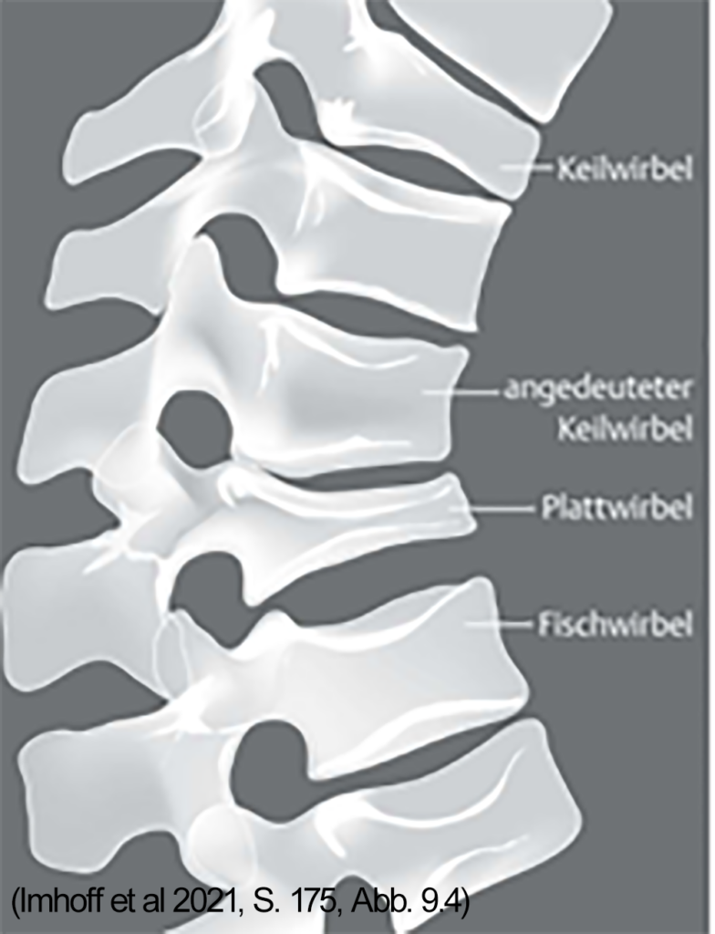 Was ist Osteoporose? - Ein Überblick | PraxisMalz